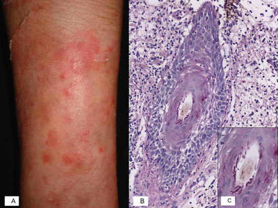 JoF | Free Full-Text | Unusual Inflammatory Tinea Infections: Majocchi ...