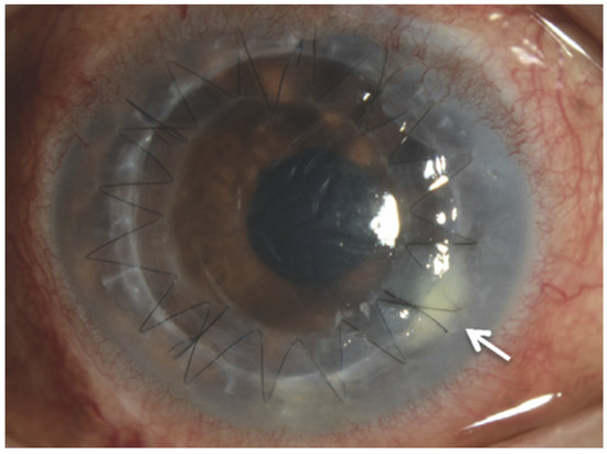 Fungal Endophthalmitis: A Comprehensive Review