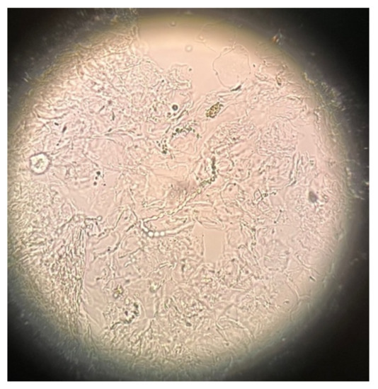 Tinea Incognito—A Great Physician Pitfall