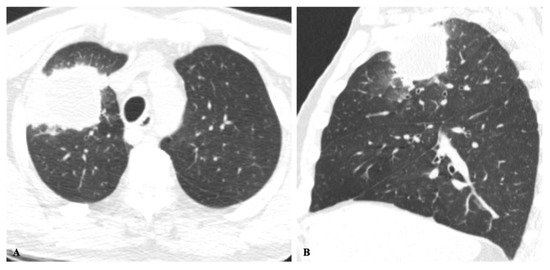 Chest Imaging in Systemic Endemic Mycoses