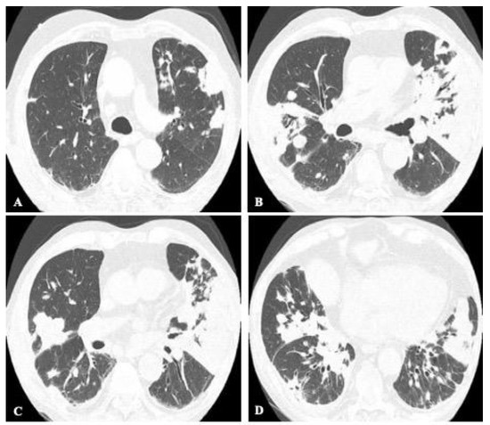Chest Imaging in Systemic Endemic Mycoses