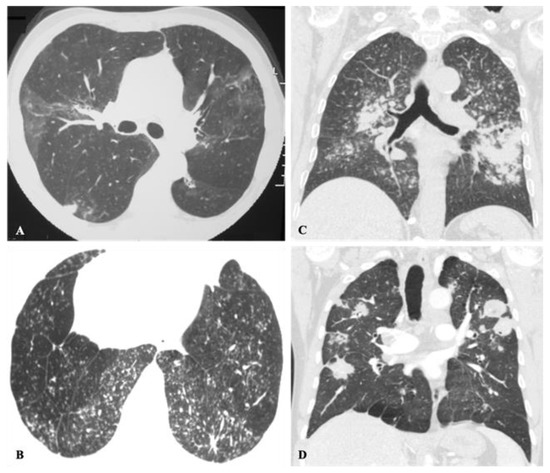 Chest Imaging in Systemic Endemic Mycoses