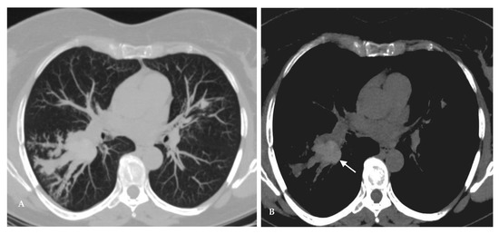 Chest Imaging in Systemic Endemic Mycoses