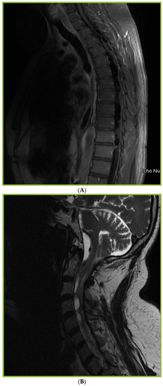 Spinal Arachnoiditis in Patients with Coccidioidomycosis Meningitis ...