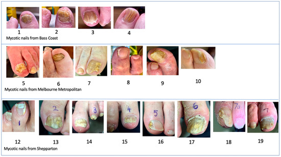Metagenomics of Toenail Onychomycosis in Three Victorian Regions of ...