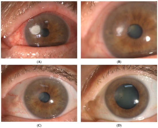 Case Series of Rare Fungal Keratitides: Experiences from a Quaternary ...