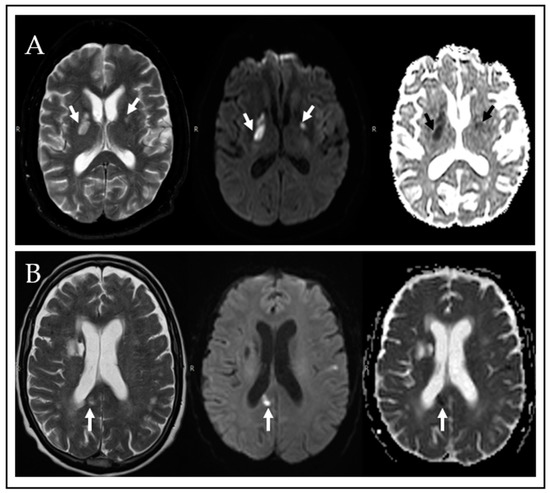 Neuroimaging of Cryptococcal Meningitis in Patients without Human ...