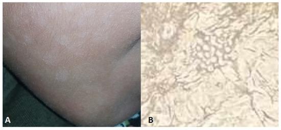 Atypical and Unpredictable Superficial Mycosis Presentations: A ...