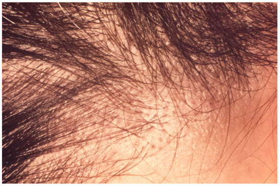 Comprehensive Review of Tinea Capitis in Adults: Epidemiology, Risk ...