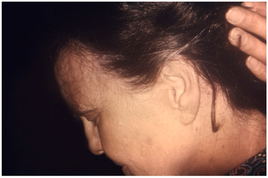 Comprehensive Review of Tinea Capitis in Adults: Epidemiology, Risk ...