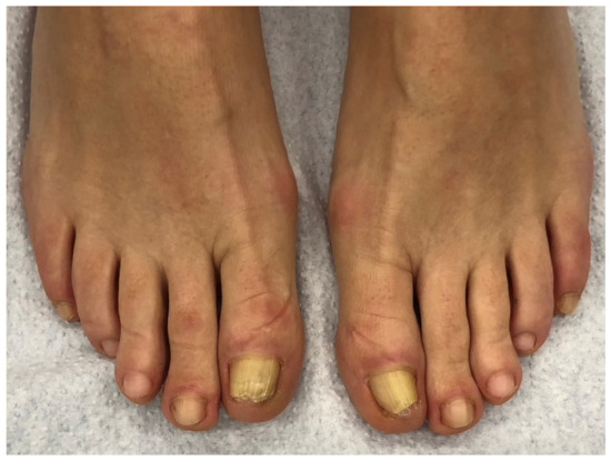JoF | Free Full-Text | Onychomycosis in Foot and Toe Malformations