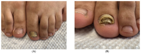 JoF | Free Full-Text | Onychomycosis in Foot and Toe Malformations