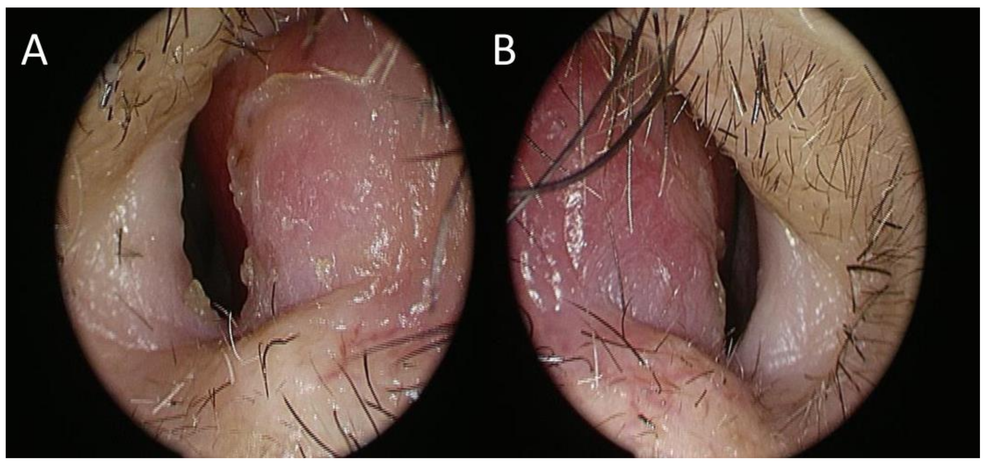 Symptoms of fungal sinus infection store