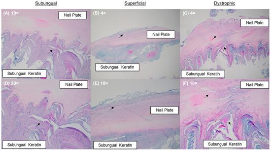 Epidemiology of Onychomycosis in the United States Characterized Using ...