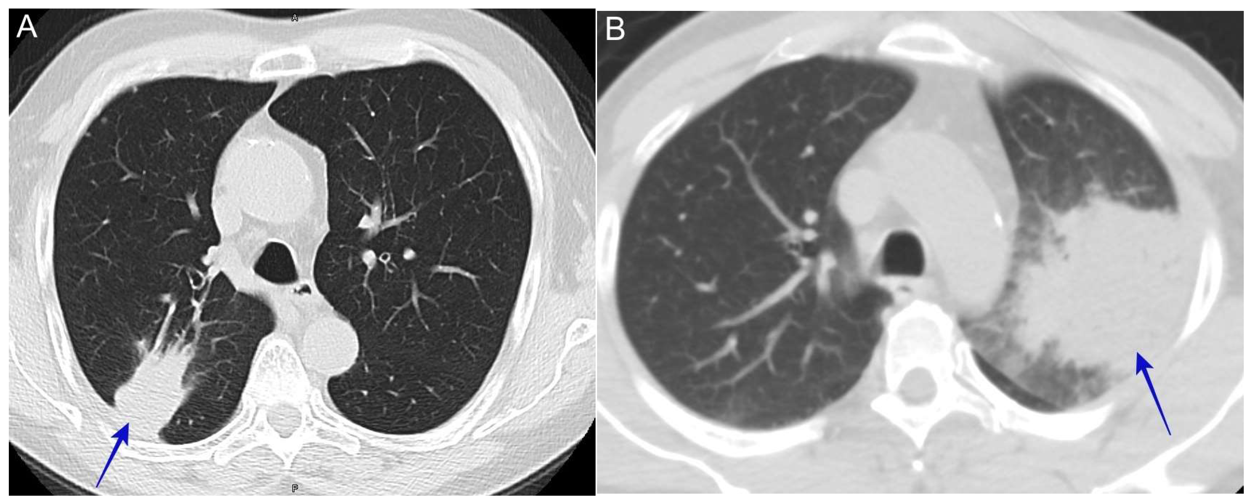 Overview of the Current Challenges in Pulmonary Coccidioidomycosis
