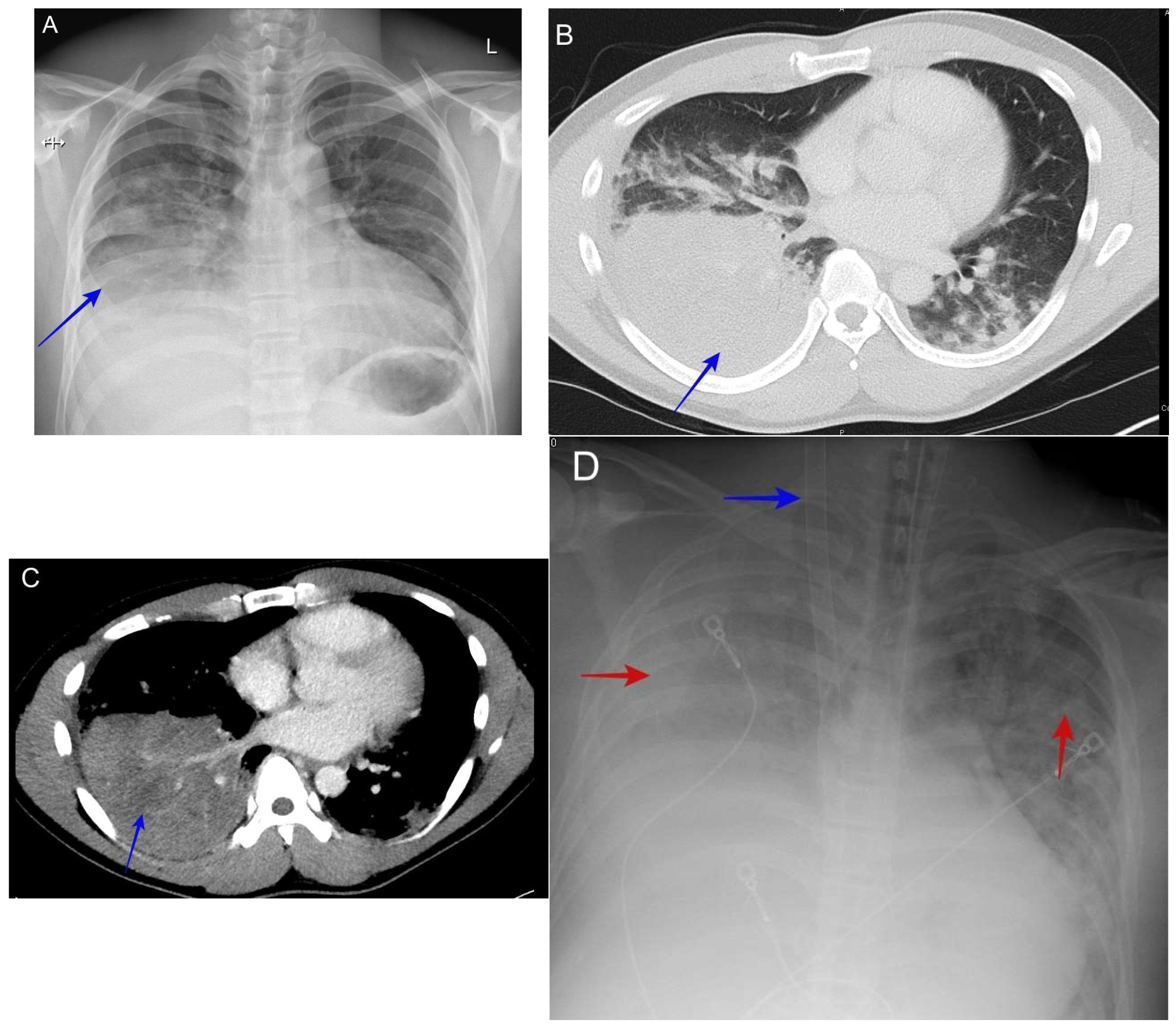 Overview of the Current Challenges in Pulmonary Coccidioidomycosis