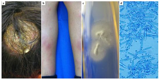 Erythema Nodosum Associated with Kerion: A Case Series and Narrative ...