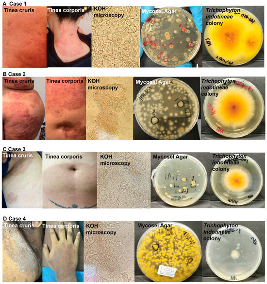 Dermatophytoses Caused by Trichophyton indotineae: The First Case ...