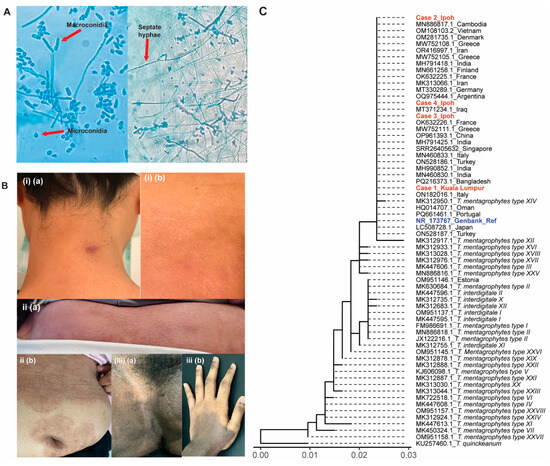 Dermatophytoses Caused by Trichophyton indotineae: The First Case ...