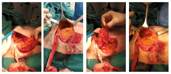 Immediate Breast Reconstruction with LICAP and AICAP Flaps: A ...