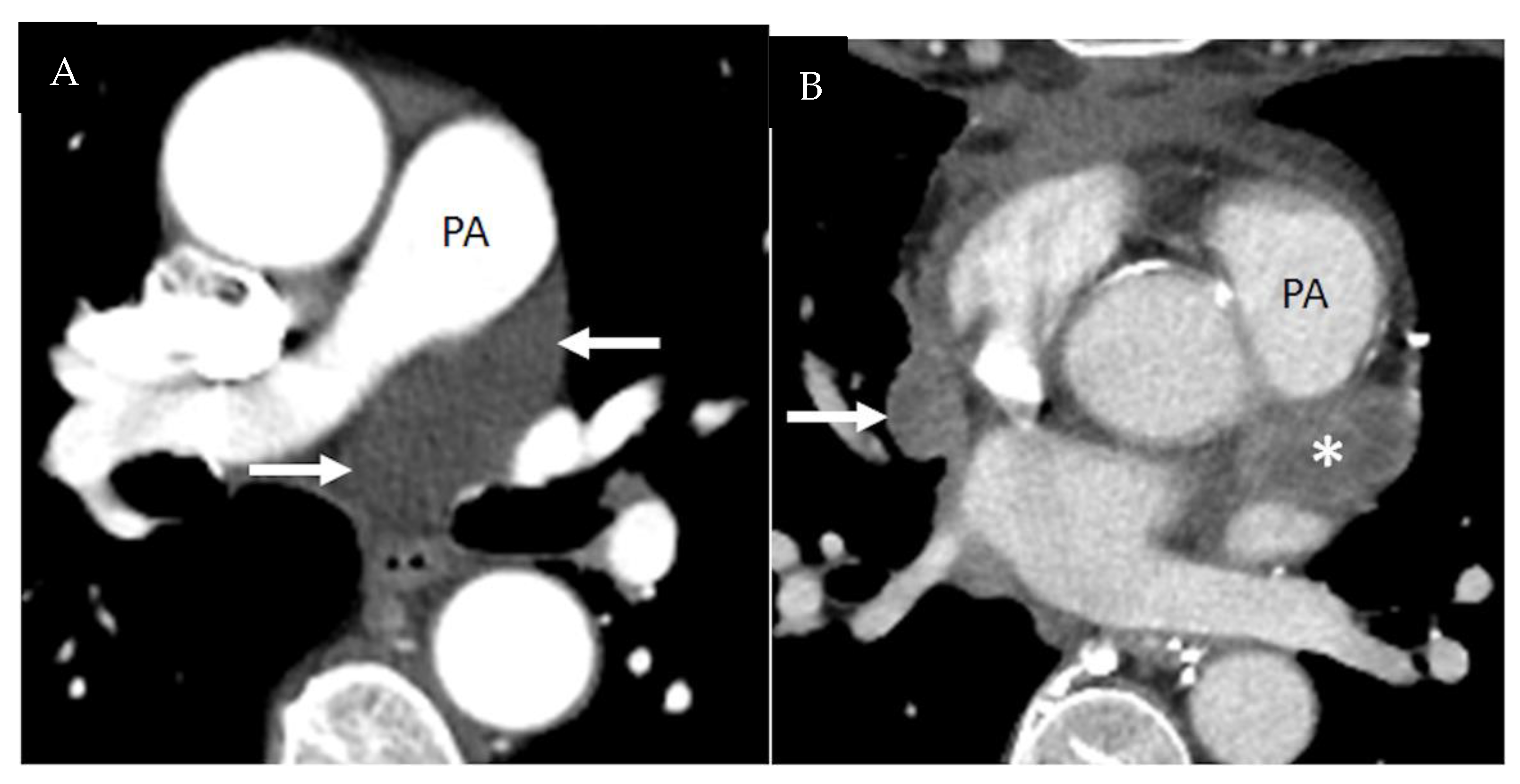 Pericardial Recesses Mimicking Mediastinal Adenopathy on CT
