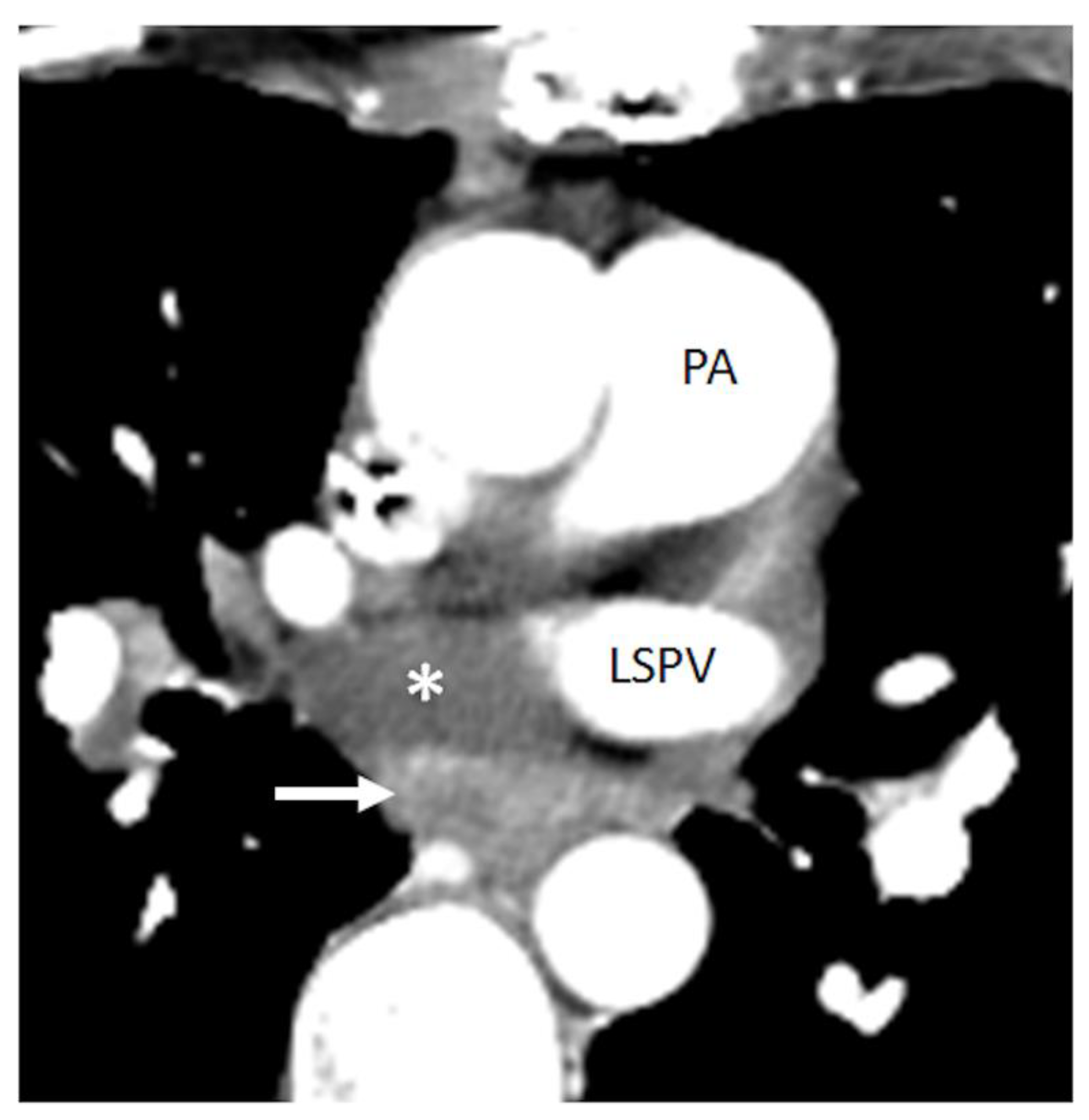 Pericardial Recesses Mimicking Mediastinal Adenopathy on CT