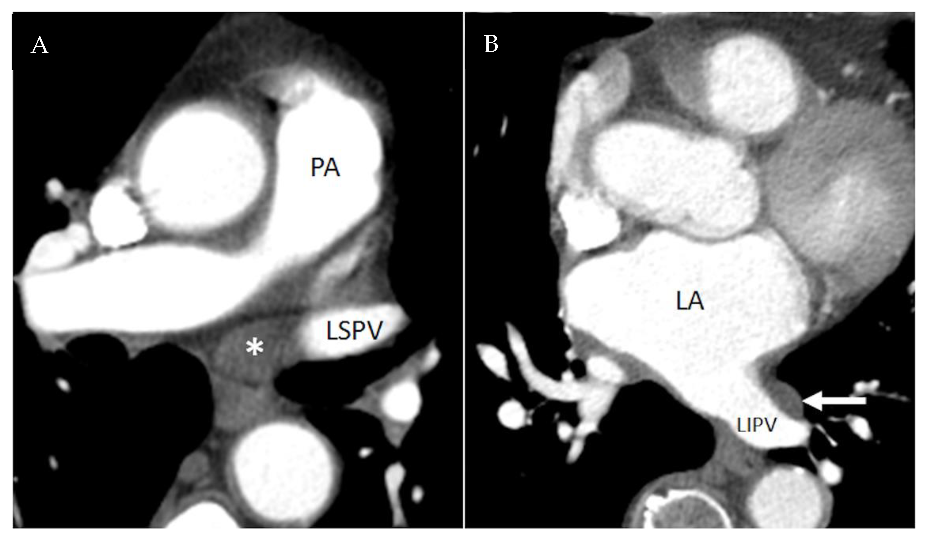 Pericardial Recesses Mimicking Mediastinal Adenopathy on CT