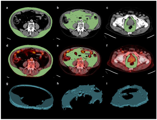 Prognostic Value of CT-Attenuation and 18F-Fluorodeoxyglucose Uptake of ...