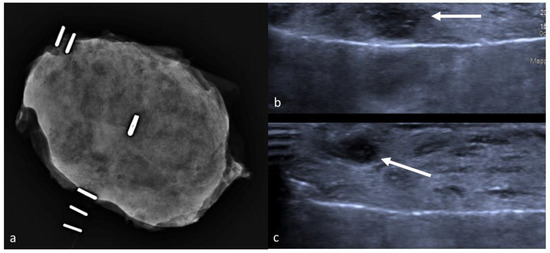 Image-Guided Localization Techniques for Surgical Excision of Non-Palpable Breast Lesions: An ...