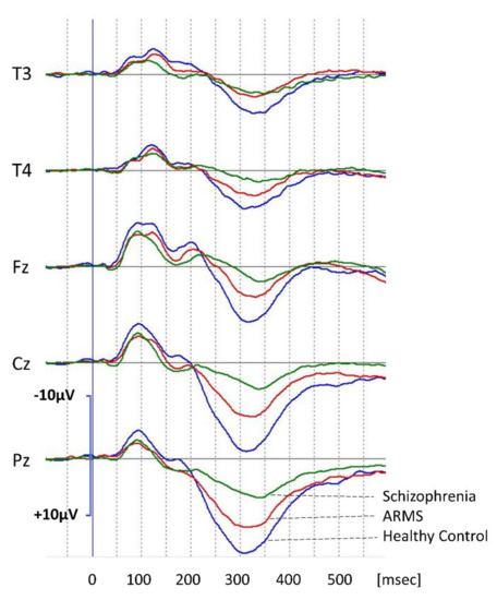JPM | Free Full-Text | Prolonged P300 Latency in Antipsychotic-Free ...
