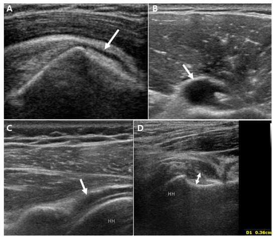 Comparison of Shoulder Ultrasonographic Assessments between Polymyalgia ...