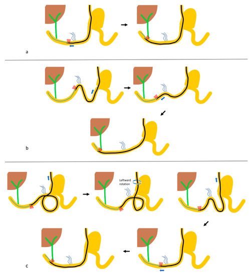 Outcomes and Loop Pattern Analysis of a Road-Map Technique for ERCP ...