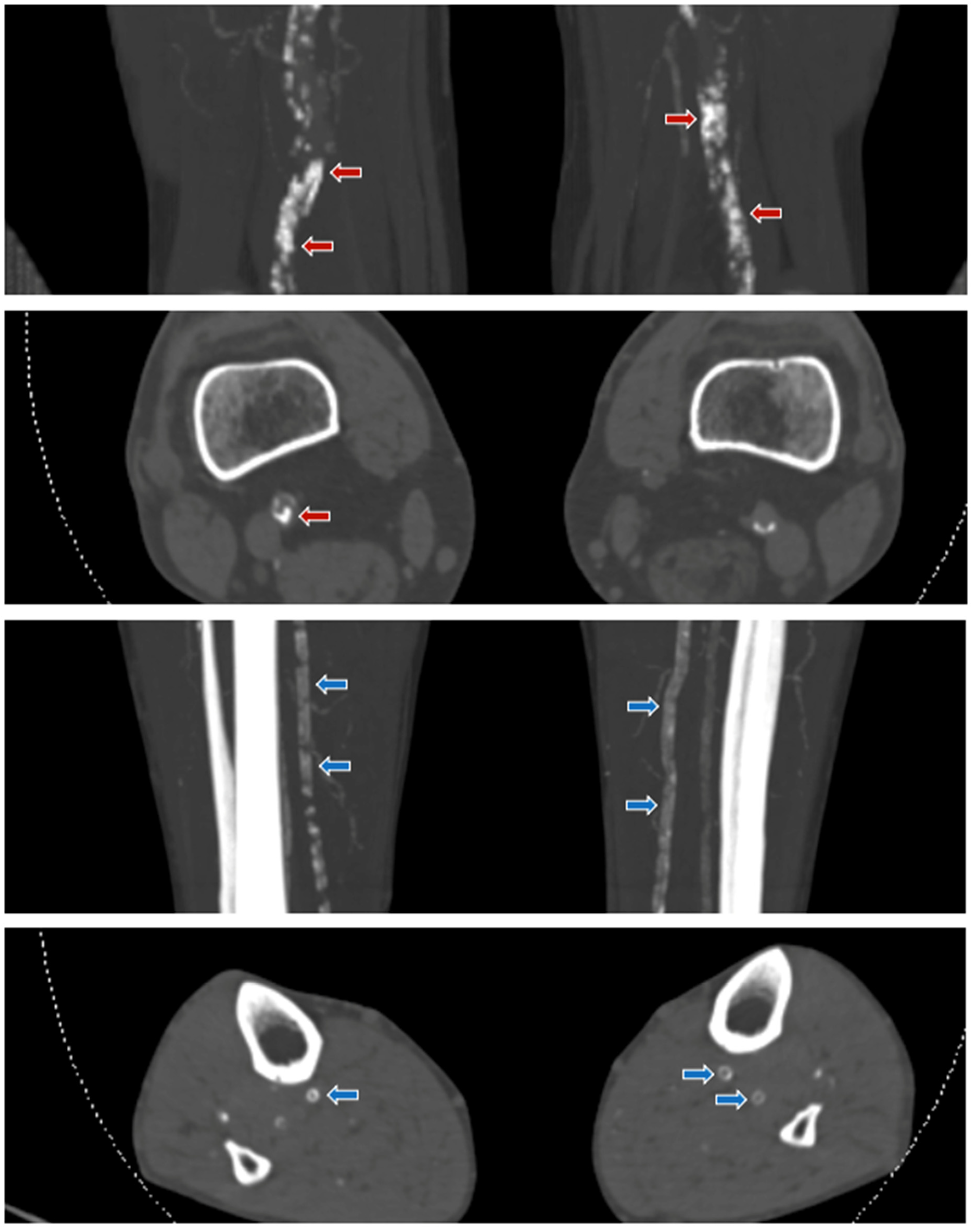 Different Lower Extremity Arterial Calcification Patterns in Patients ...