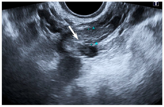 The Effect of Venoactive Drug Therapy on the Development and Severity ...