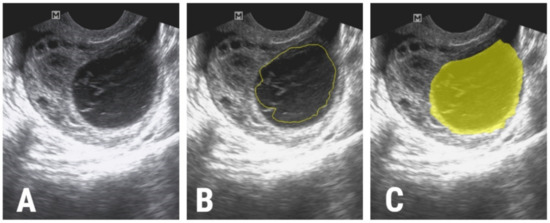 Ultrasonography in the Differentiation of Endometriomas from ...