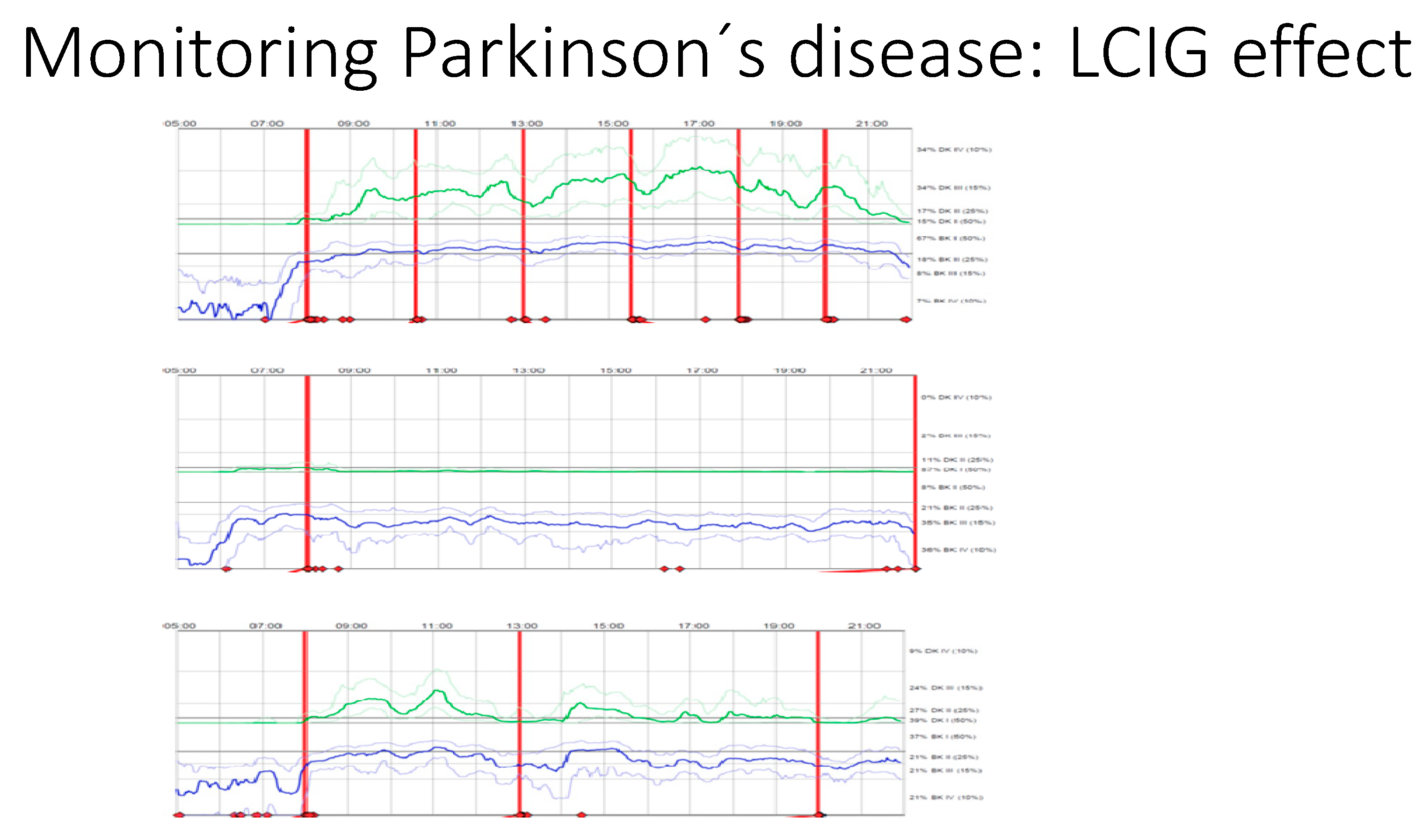 Parkinson’s Disease: Personalized Pathway of Care for Device-Aided ...