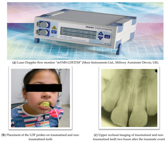 Efficacy of Laser Doppler Flowmetry, as a Diagnostic Tool in Assessing ...