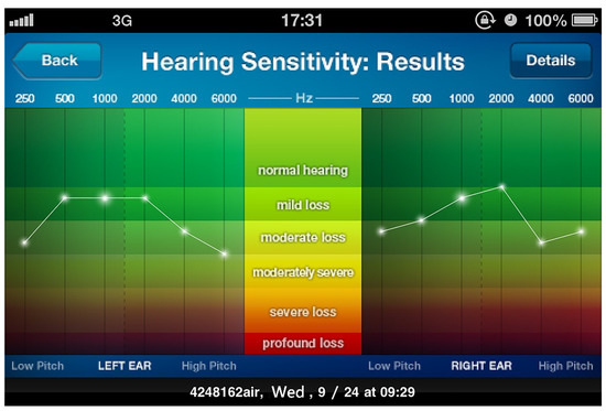Validation of a Personalized Hearing Screening Mobile Health ...