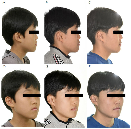 Individualized 3D-Printed Bone-Anchored Maxillary Protraction Device ...
