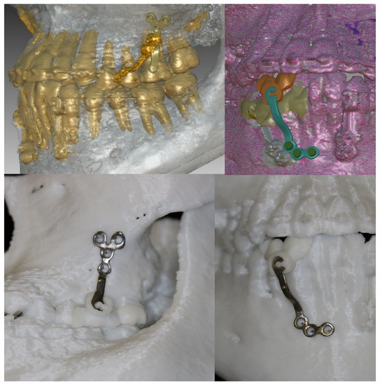 Individualized 3D-Printed Bone-Anchored Maxillary Protraction Device ...