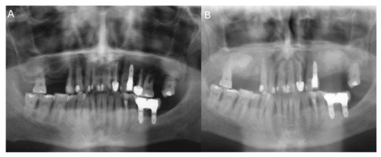 A Replicable and Reproducible Digital Method for Quantifying Maxillary ...