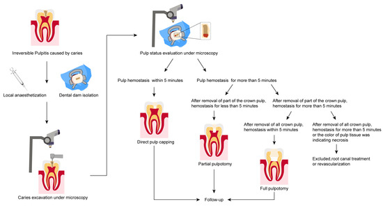 JPM | Free Full-Text | Vital Pulp Therapy in Permanent Teeth with ...