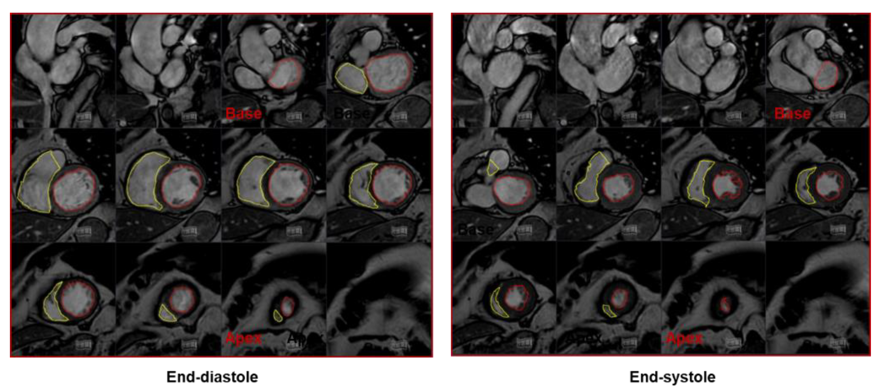 Non-Invasive Assessment of Left Ventricle Ejection Fraction: Where Do ...