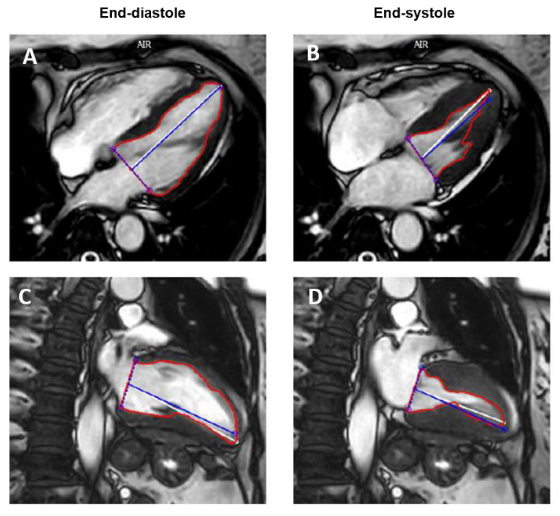 Non-Invasive Assessment of Left Ventricle Ejection Fraction: Where Do We Stand?