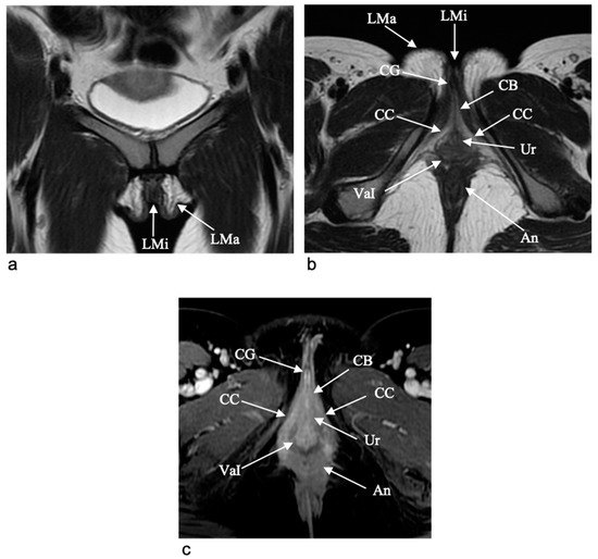 MRI Staging in Locally Advanced Vulvar Cancer: From Anatomy to Clinico ...