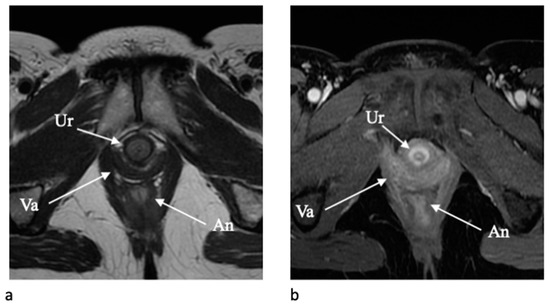MRI Staging in Locally Advanced Vulvar Cancer: From Anatomy to Clinico ...
