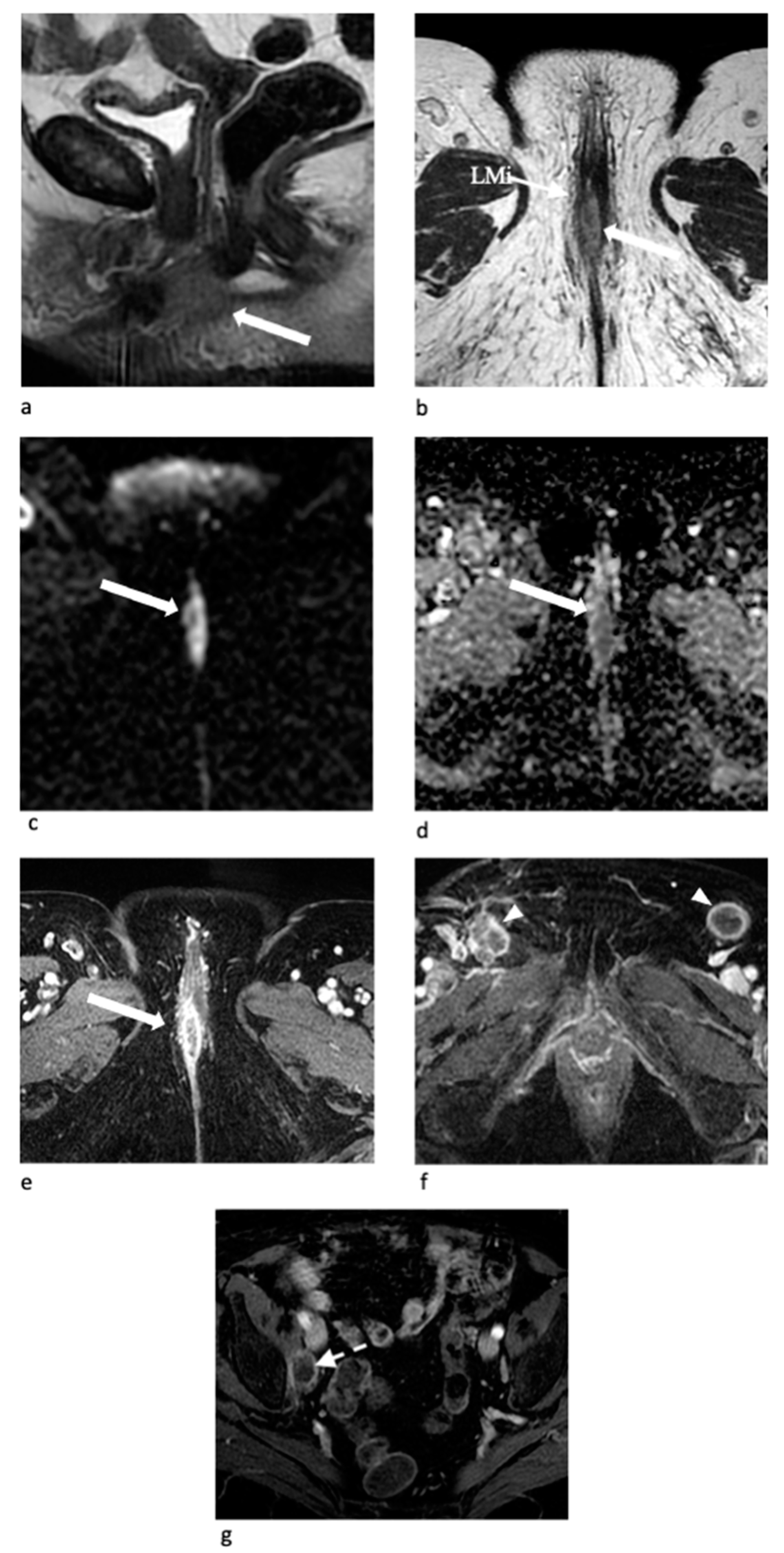 Jpm Free Full Text Mri Staging In Locally Advanced Vulvar Cancer