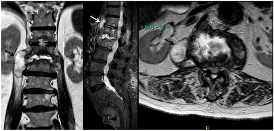 Bone and Joint Infections: The Role of Imaging in Tailoring Diagnosis ...