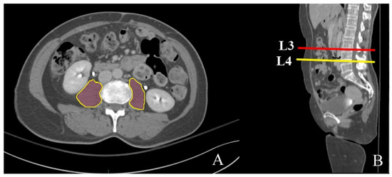 Psoas Muscle Volume as an Opportunistic Diagnostic Tool to Assess ...