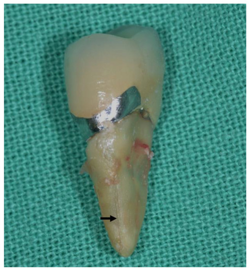 Vertical Root Fracture in Non-Endodontically and Endodontically Treated ...
